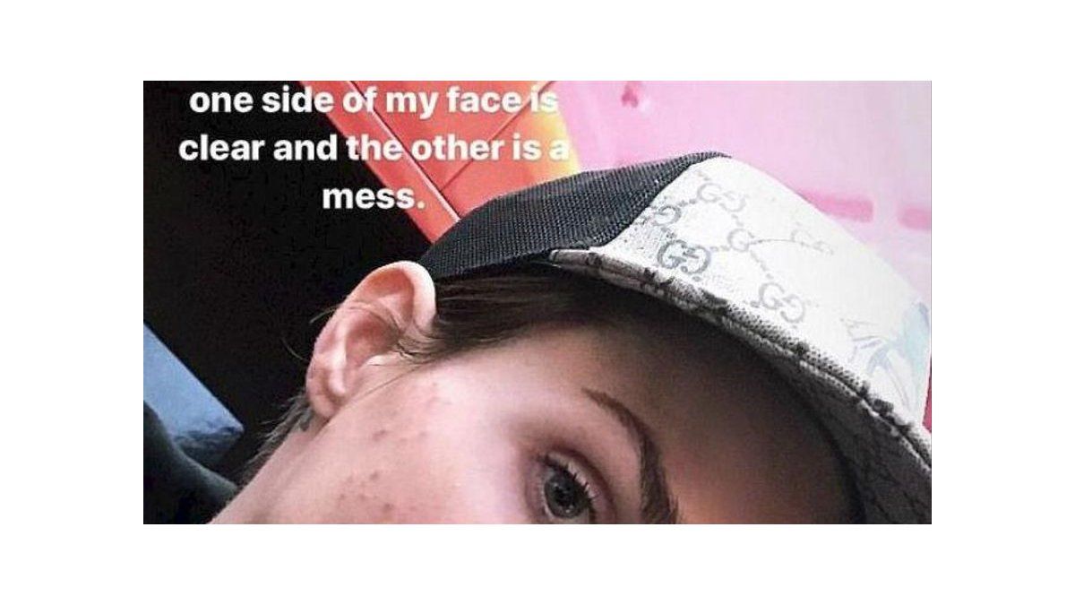 Ruby Rose defiende orgullosa su acné