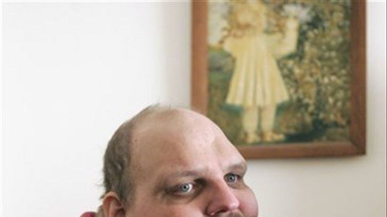 Mala salud persigue a hombre que pesó media tonelada