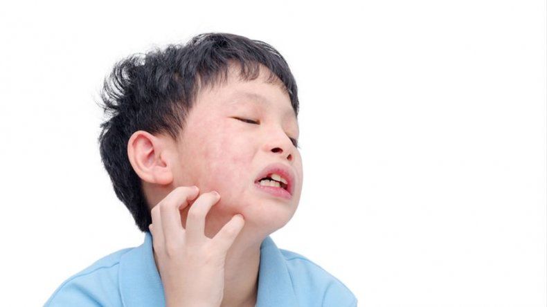 Minsa descarta brote de paperas en Panamá