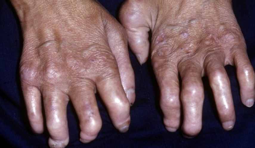 Lepra o Hansen: ¿De que trata la enfermedad que ha sido controlada en ...