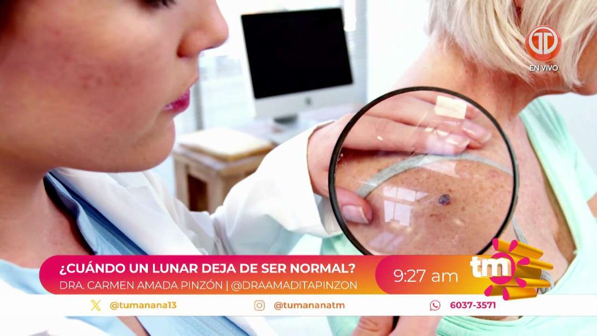 ¿Un lunar puede convertirse en cáncer? Síntomas a los que debes estar ...