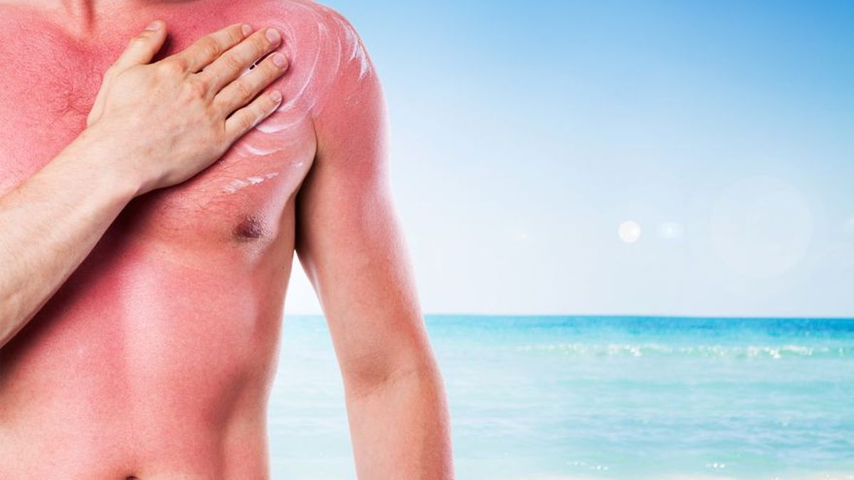 ¿Sabes cómo prevenir las quemaduras solares?