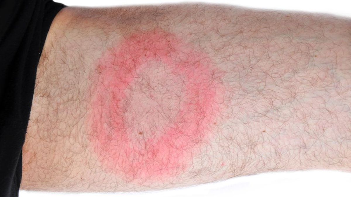 Imágenes De Erupciones Por Enfermedad De Lyme