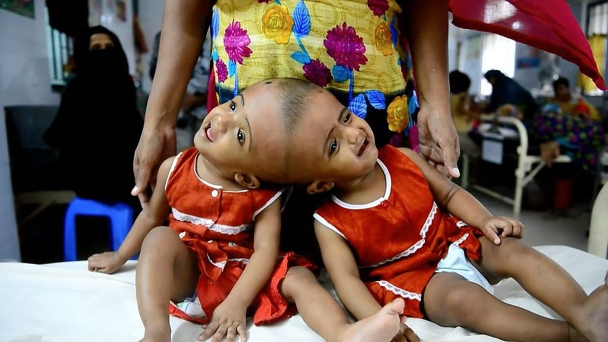 Cirugía para separar gemelos unidos por el cráneo en Bangladesh