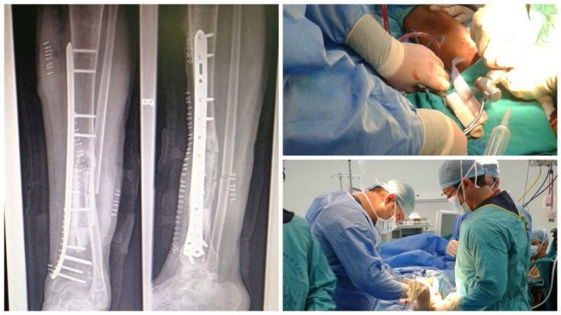 Paciente de 14 años recibe injerto de hueso para su pierna izquierda en ...