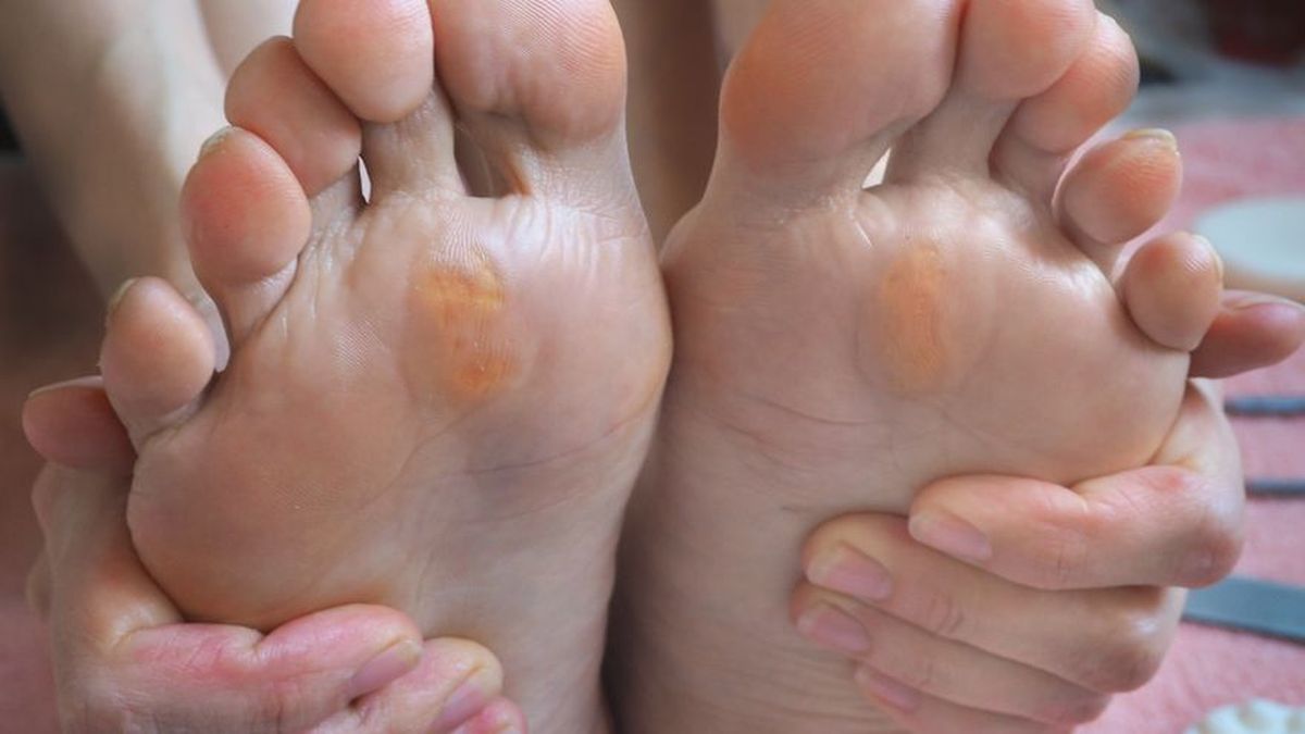 ¿Cómo eliminar los callos naturalmente?