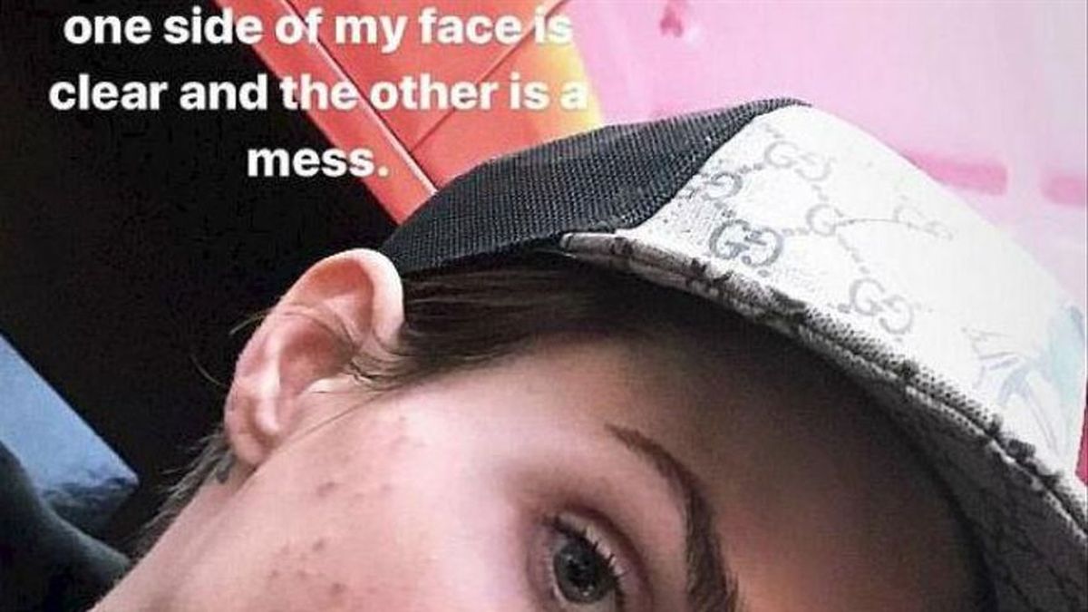 Ruby Rose defiende orgullosa su acné